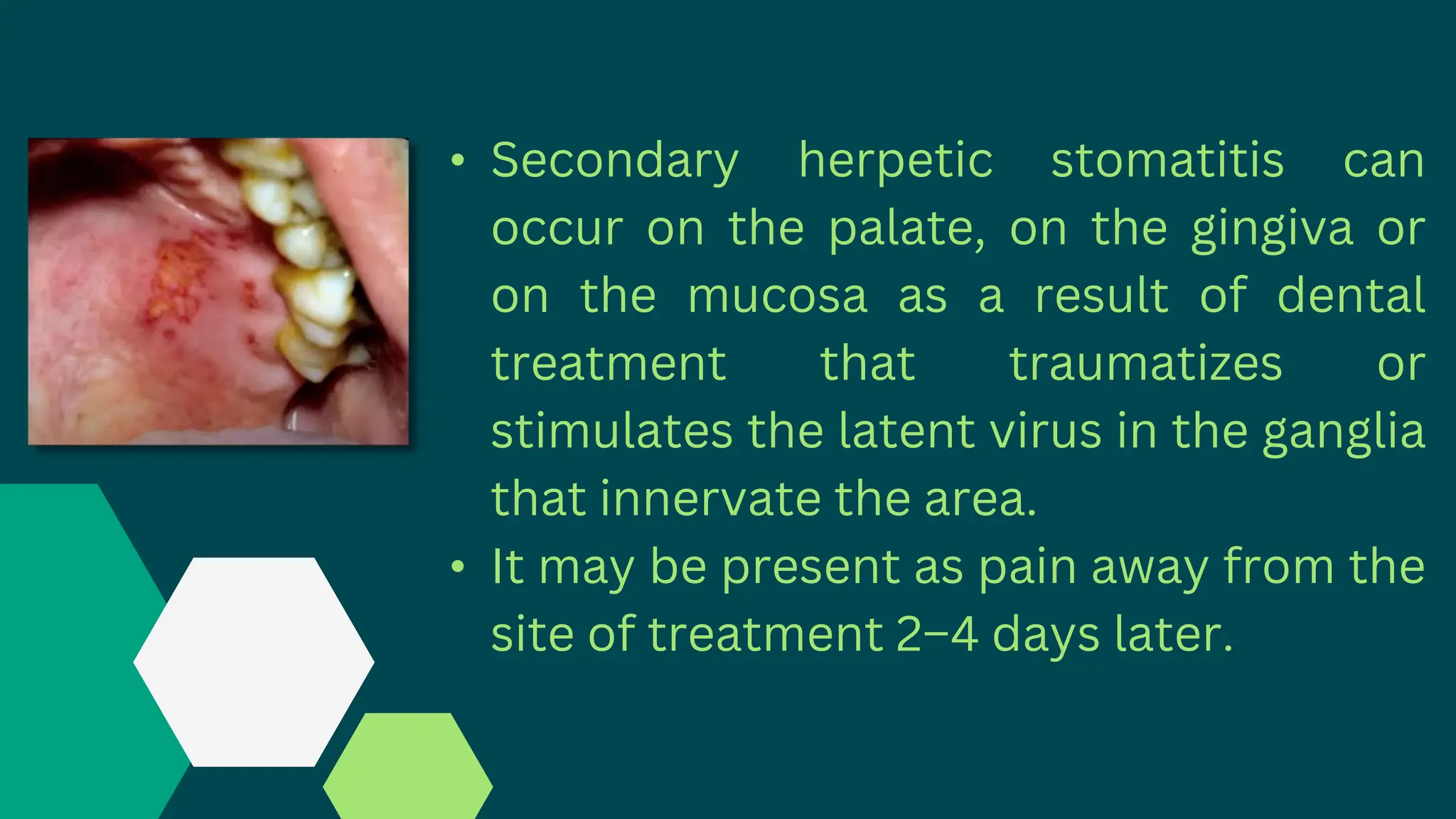 PRIMARY HERPETIC GINGIVOSTOMATITIS | PPTX
