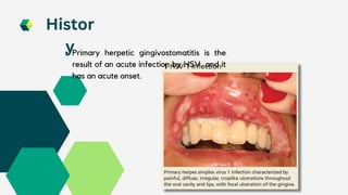 PRIMARY HERPETIC GINGIVOSTOMATITIS | PPTX