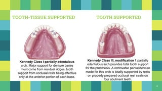 Philosophy of RPD design | PPTX