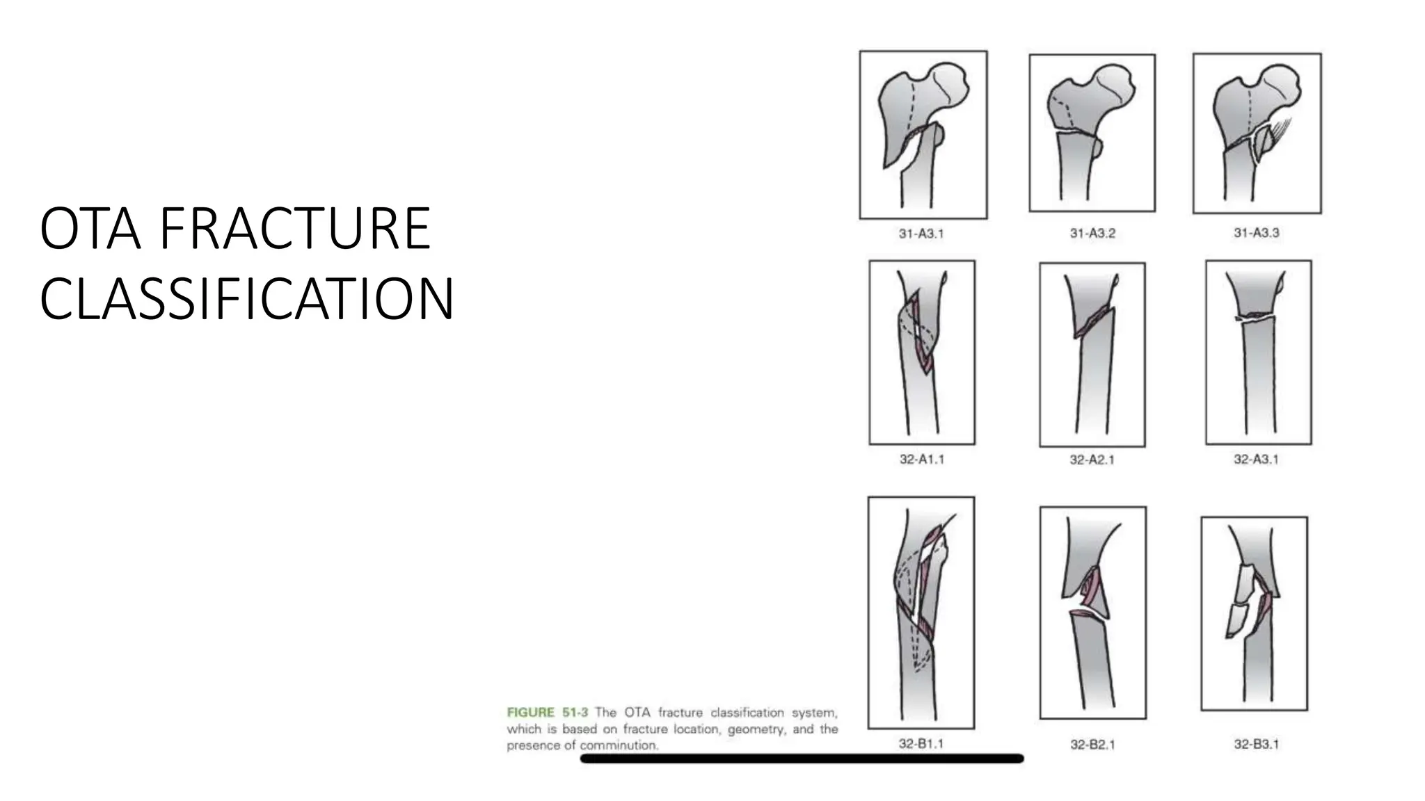 PHILOS PLATE CASE STUDY FOR SUBTROCHANTERIC FRACTURE | PPTX