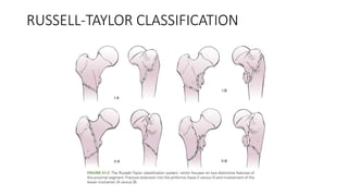 PHILOS PLATE CASE STUDY FOR SUBTROCHANTERIC FRACTURE | PPTX