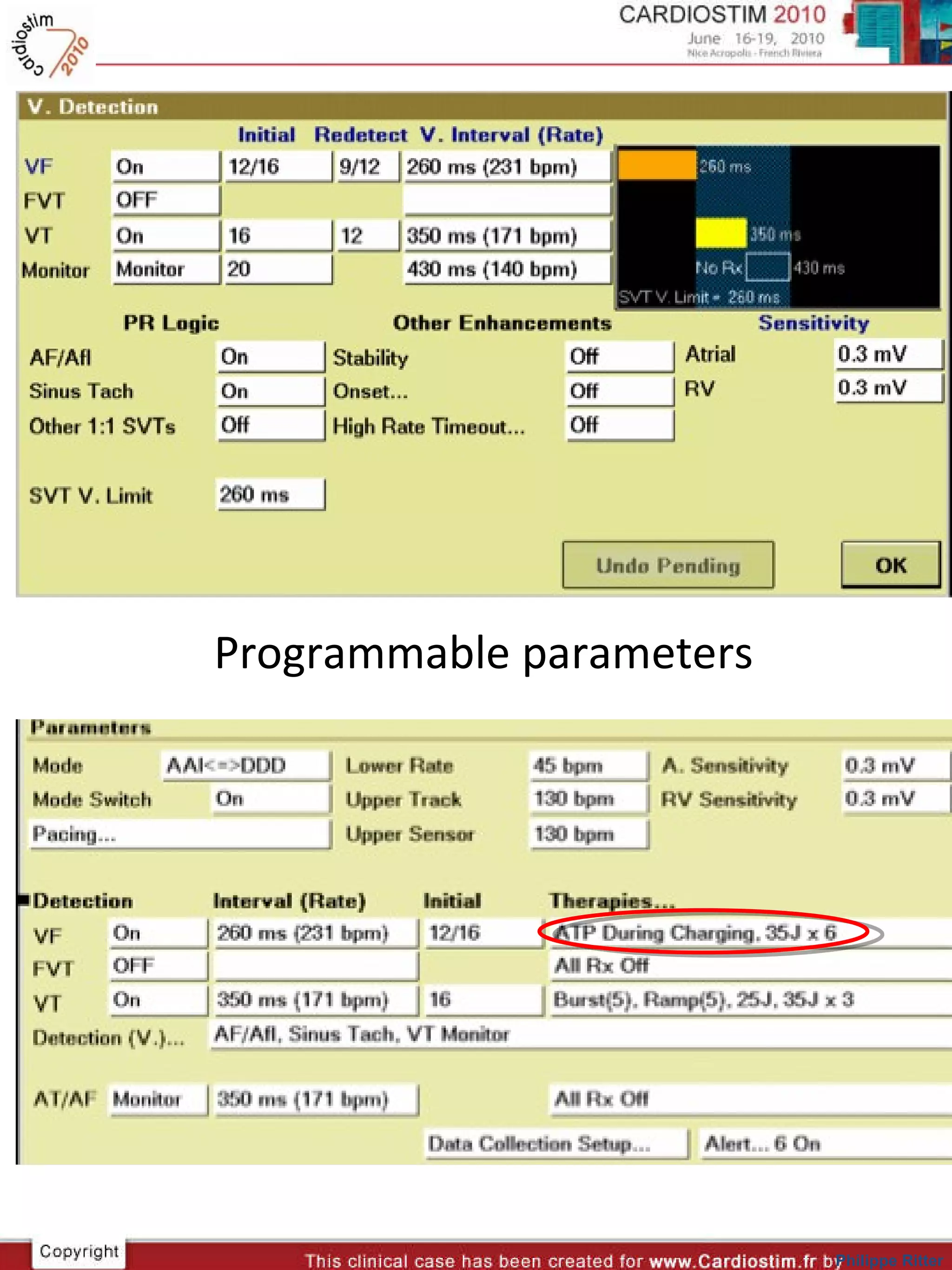 clinical case Ischemic cardiomyopathy | PPT