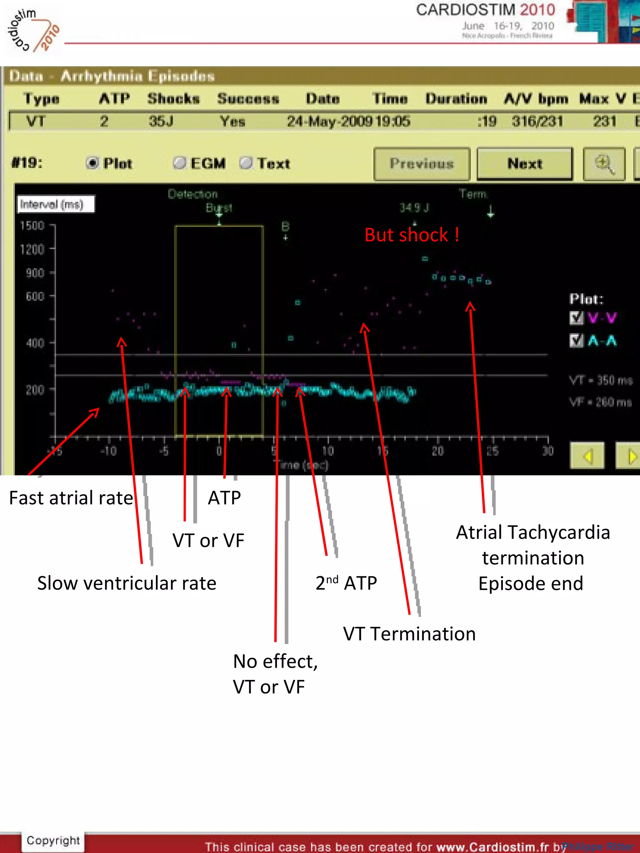 clinical case Ischemic cardiomyopathy | PPT