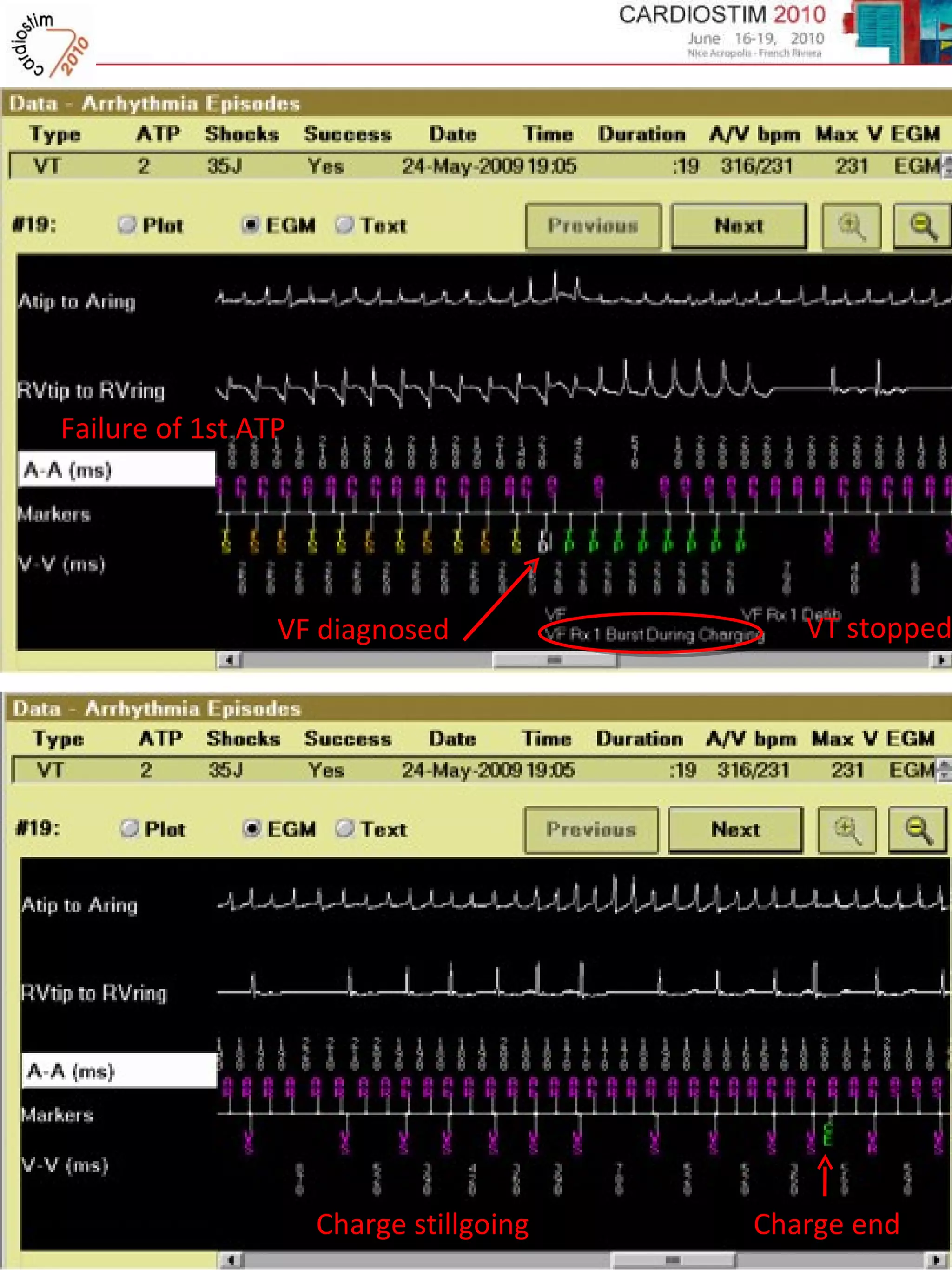 clinical case Ischemic cardiomyopathy | PPT