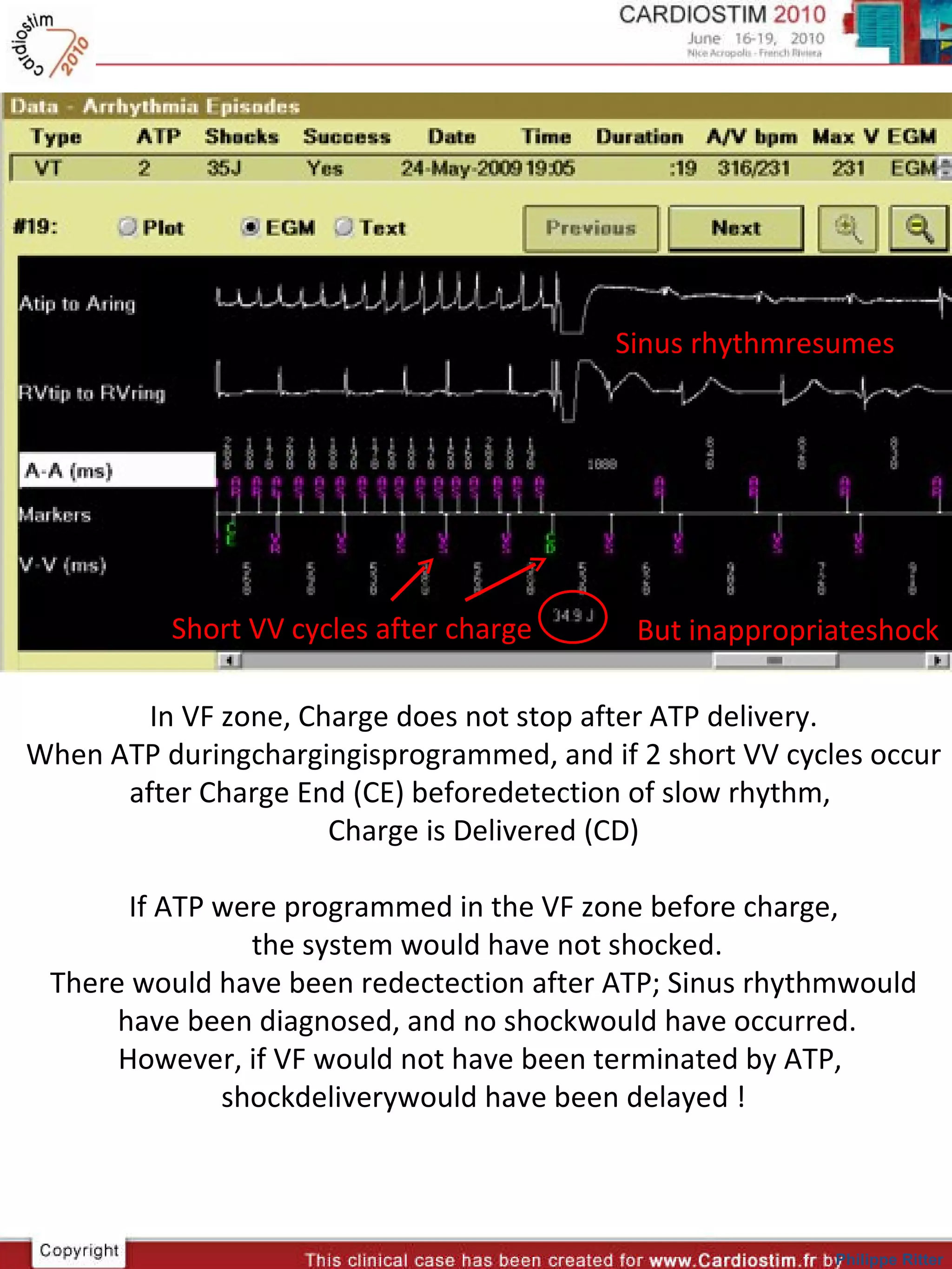 clinical case Ischemic cardiomyopathy | PPT