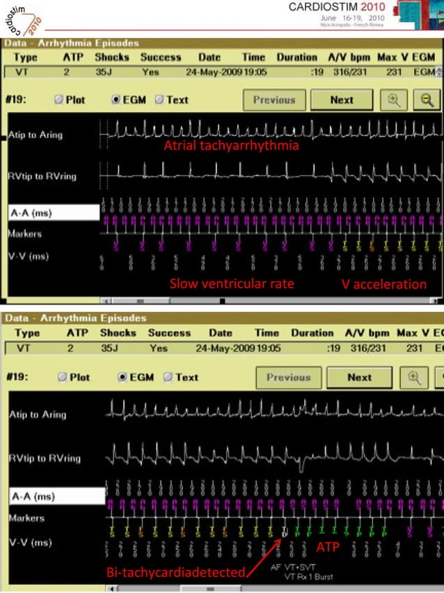 clinical case Ischemic cardiomyopathy | PPT
