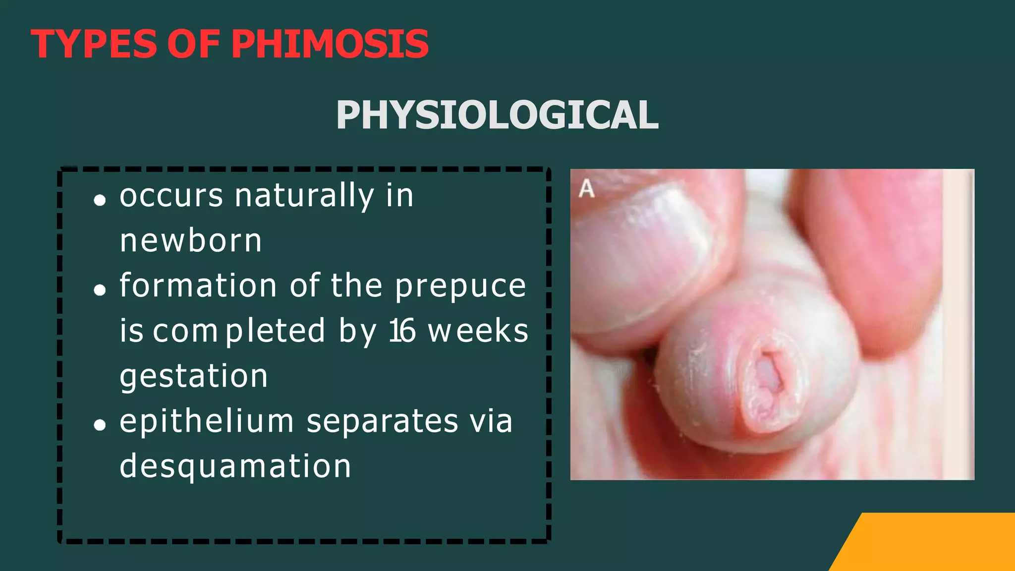 PHIMOSIS PARAPHIMOSIS | PPTX