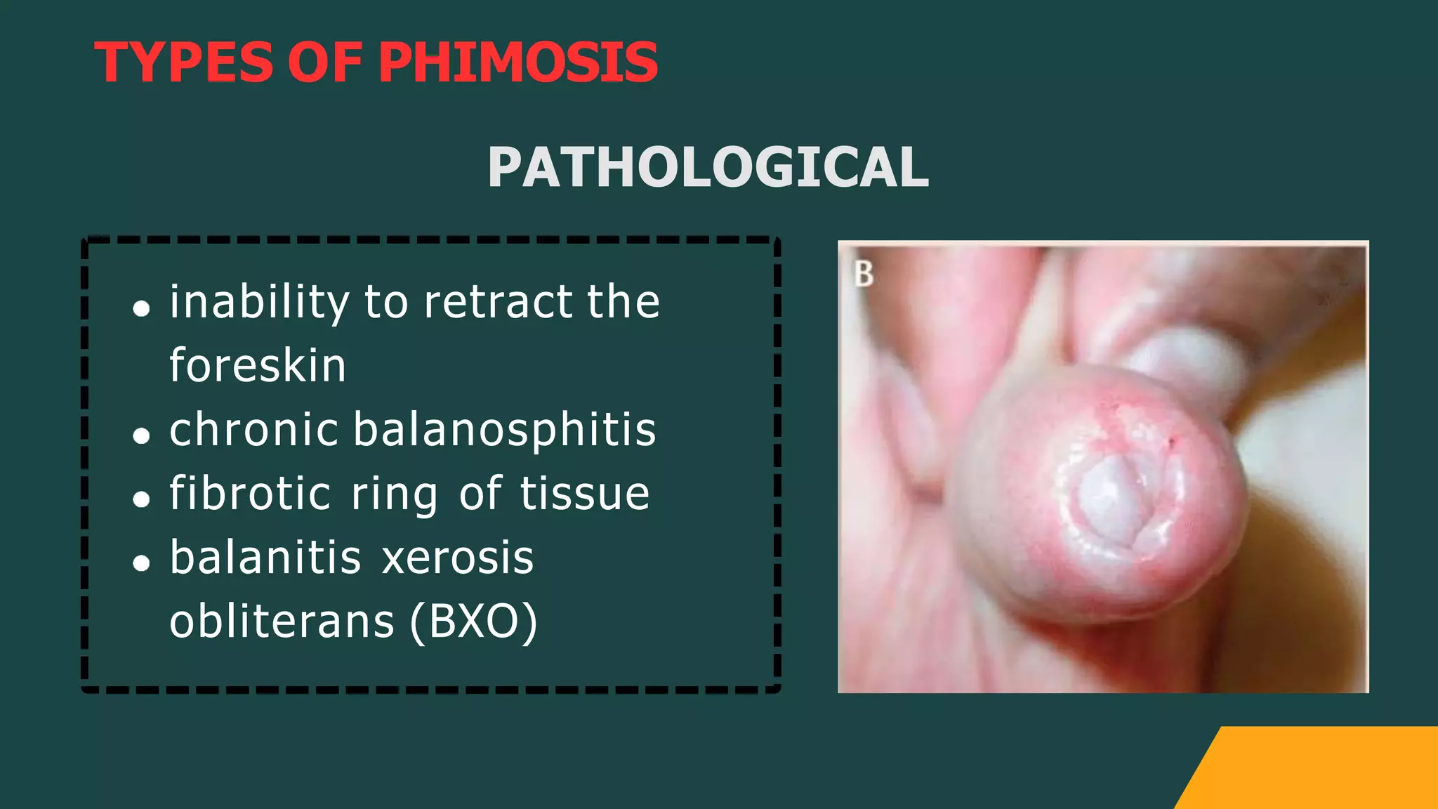 PHIMOSIS PARAPHIMOSIS | PPTX