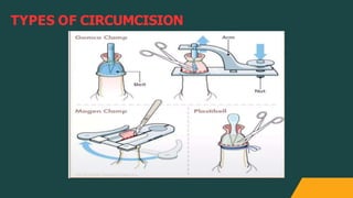 PHIMOSIS PARAPHIMOSIS | PPTX