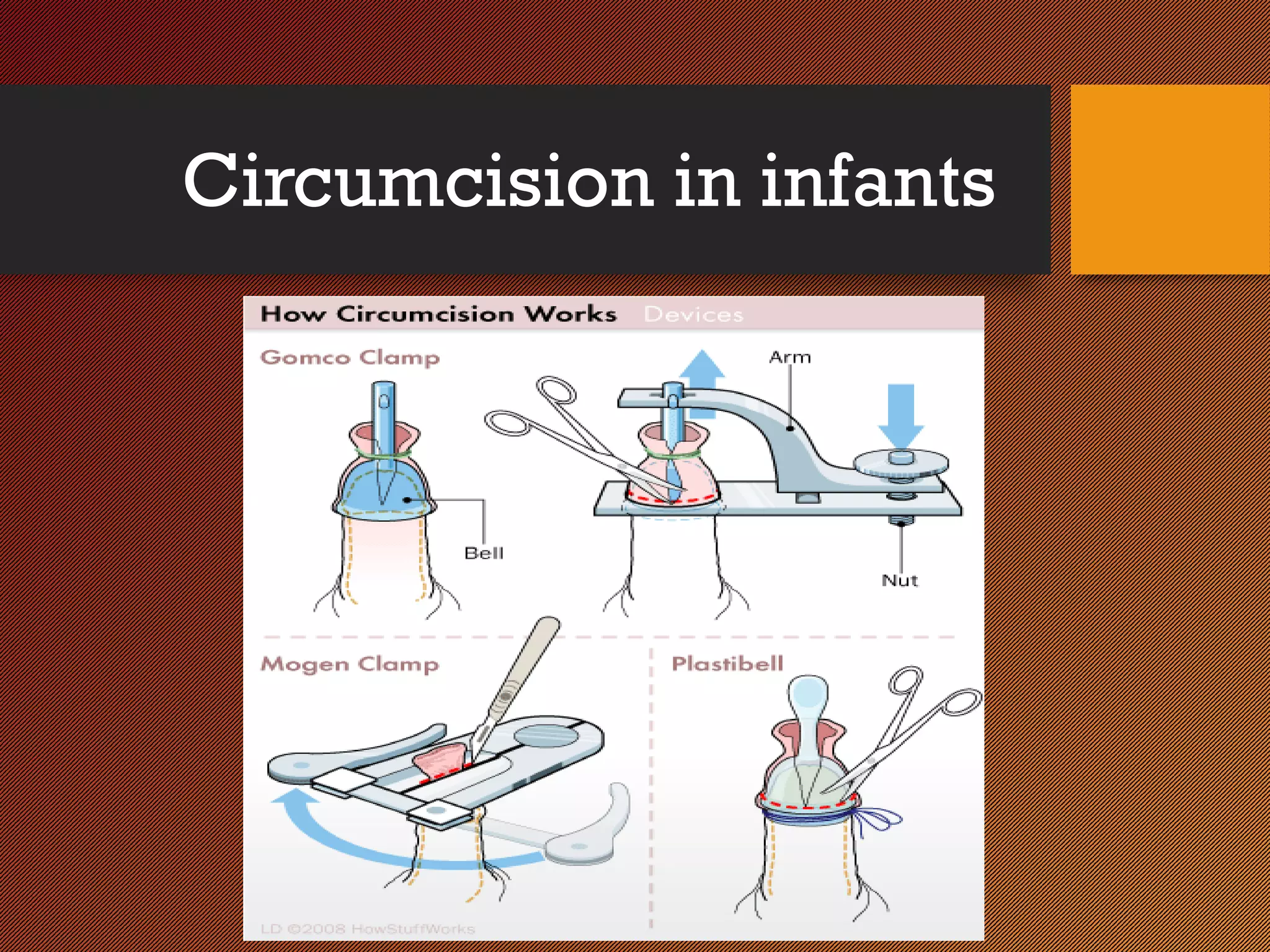 Phimosis & Paraphimosis | PPT