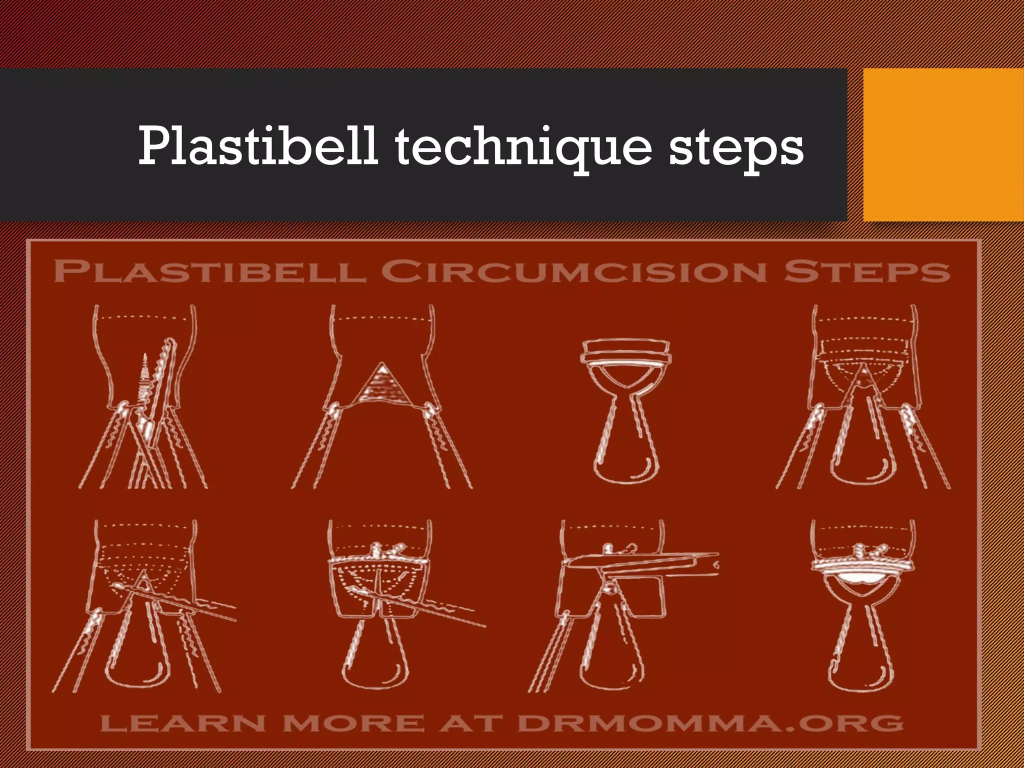Phimosis & Paraphimosis | PPT