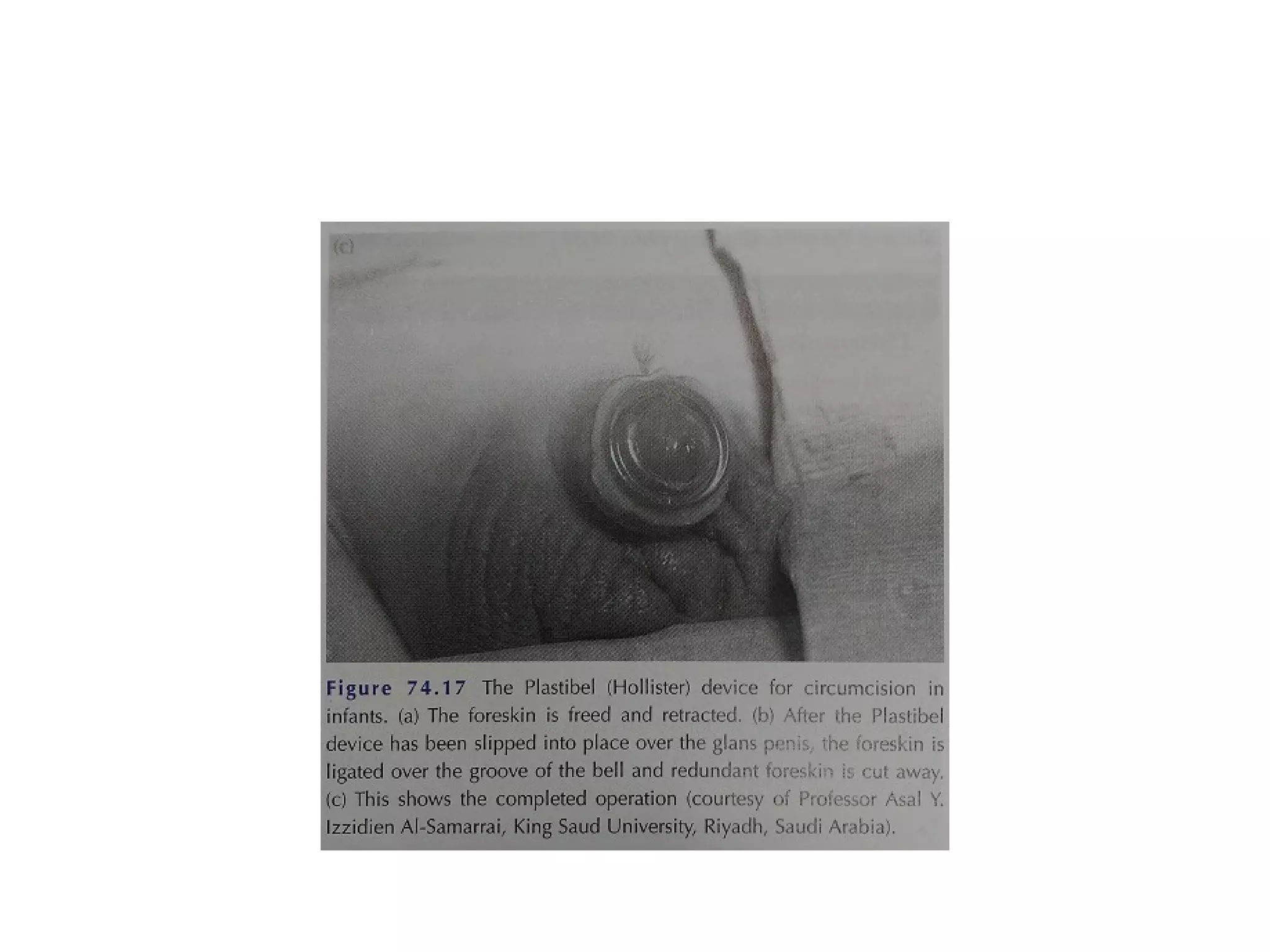 Phimosis, paraphimosis & circumcision | PPT