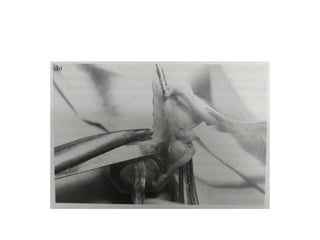 Phimosis, paraphimosis & circumcision | PPT