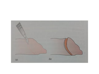 Phimosis, paraphimosis & circumcision | PPT