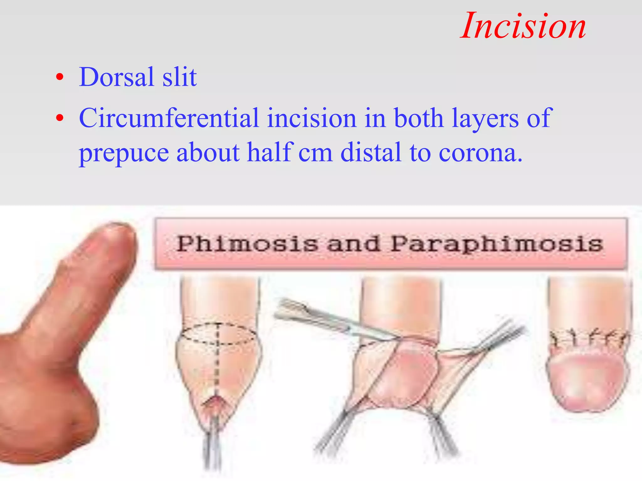 Phimosis ,paraphimosis ,circumcision.pptx