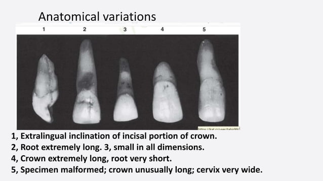 Morphology of Permanent Maxillary Central Incisor- Dr. Saba Arshad.pptx ...