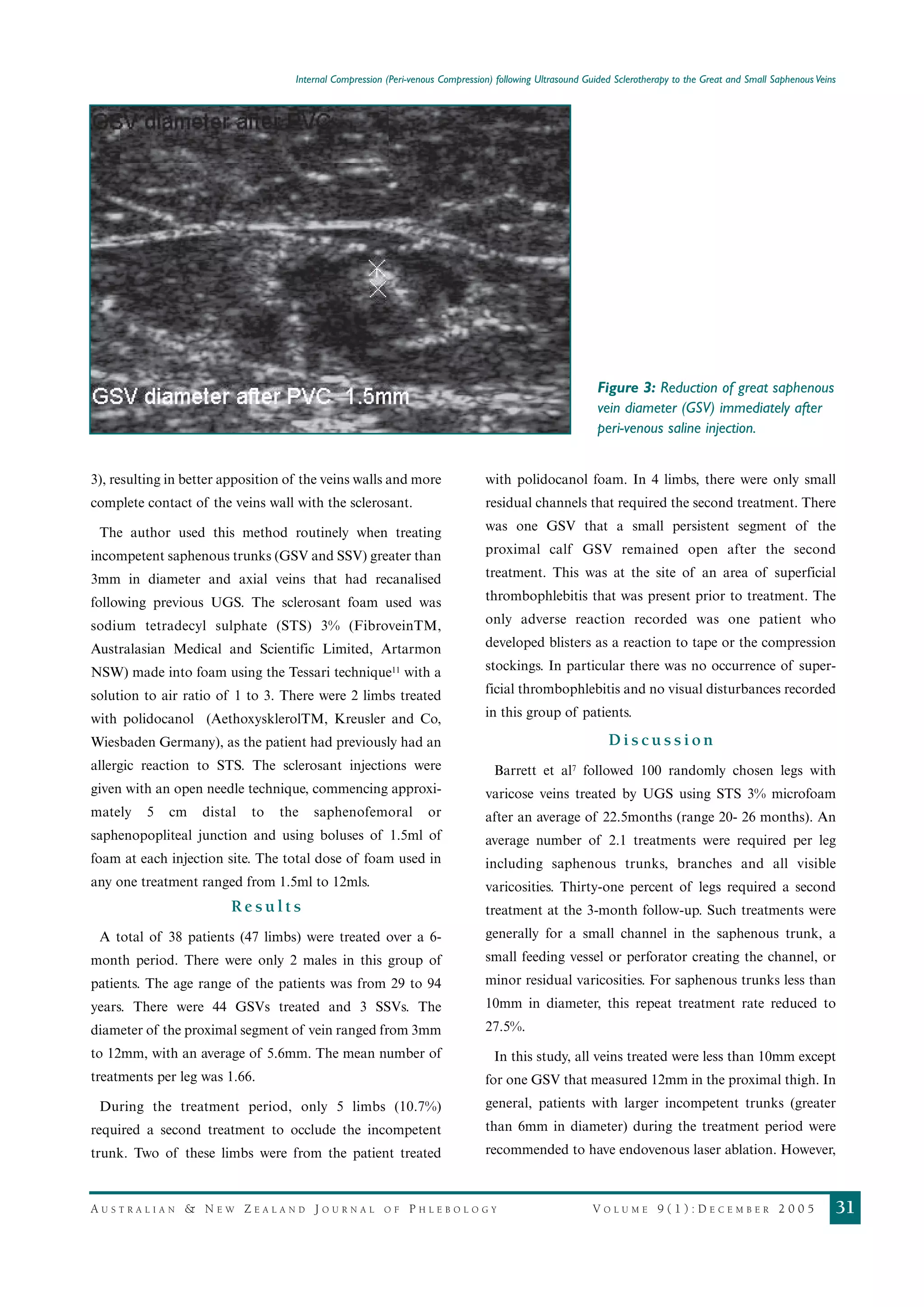 Phlebology Jrnal Dec 05 V2 | PDF