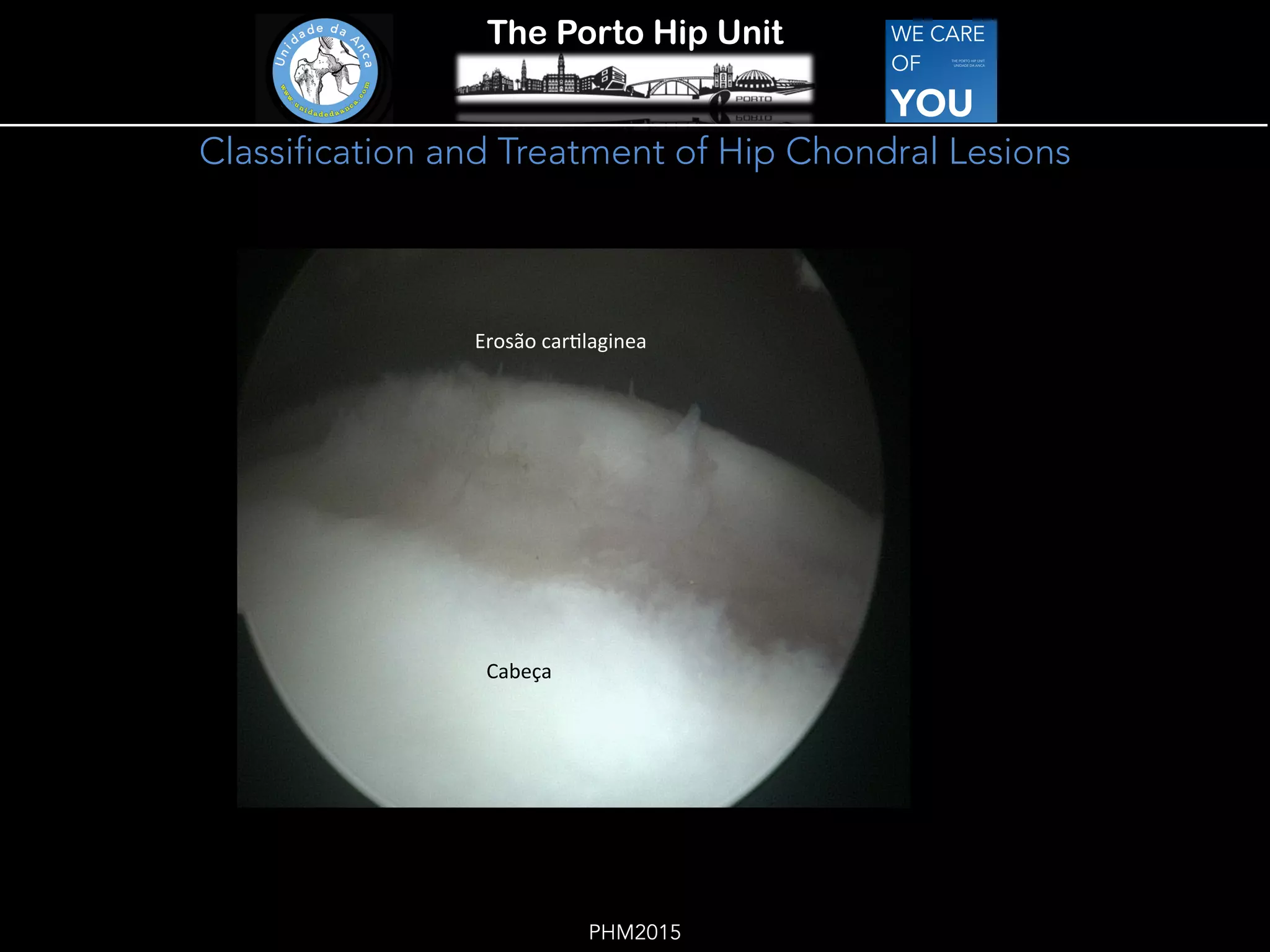 Classification and Treatment of Hip Chondral Lesions | PDF