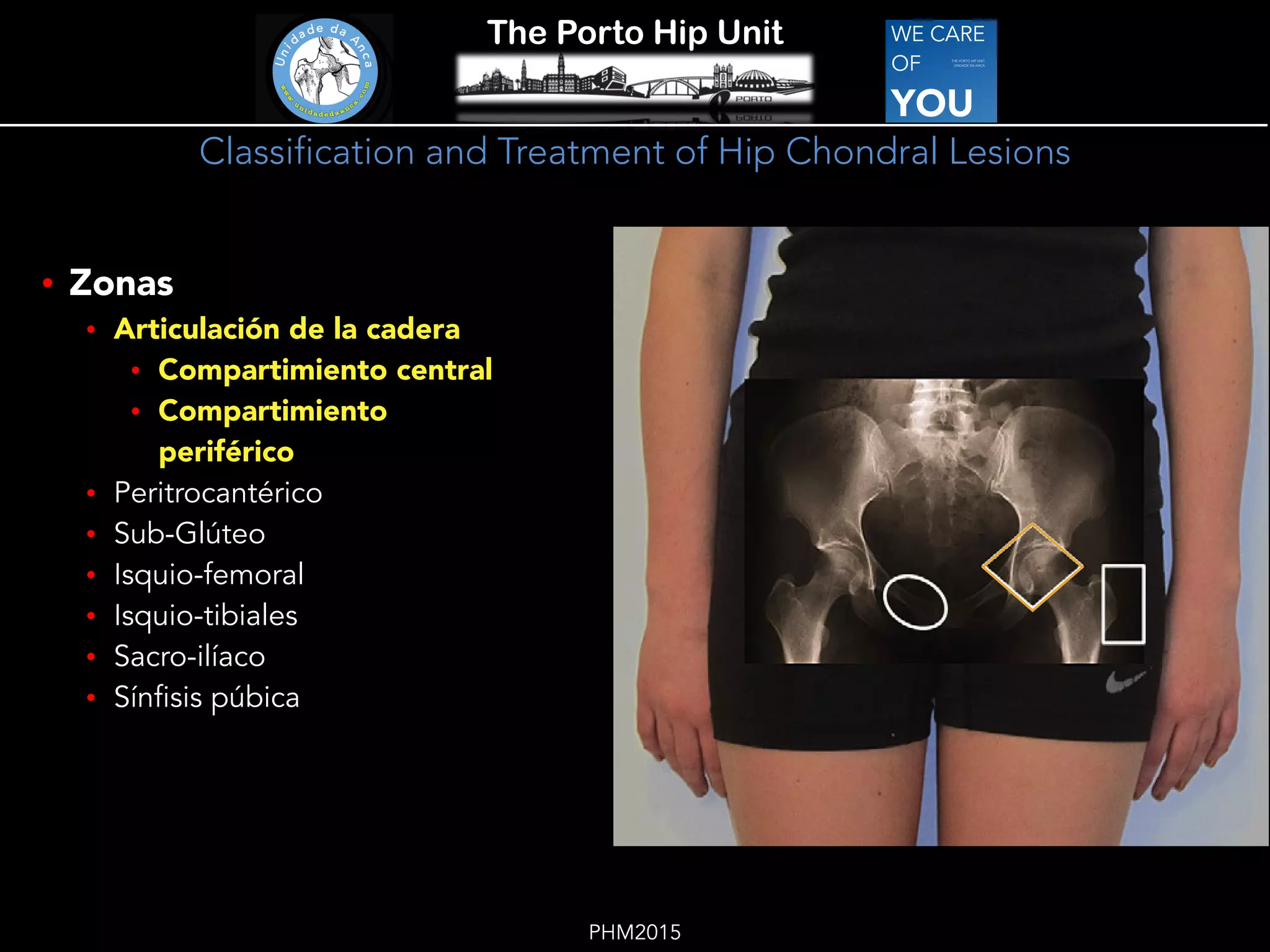 Classification and Treatment of Hip Chondral Lesions | PDF