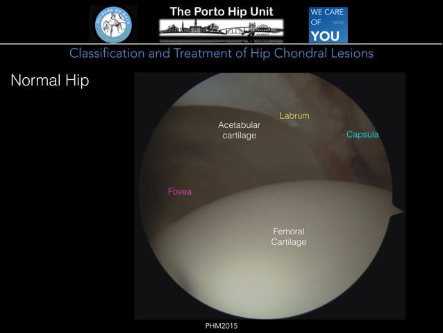 Classification and Treatment of Hip Chondral Lesions | PPT