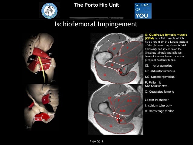 Isquiofemoral Impingement