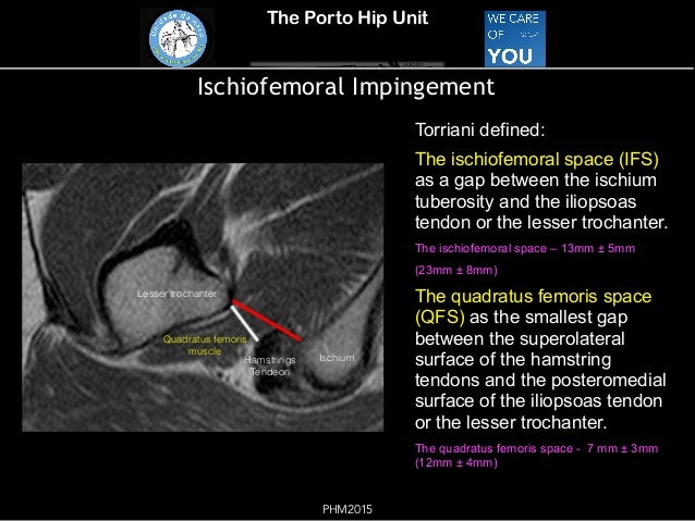 Isquiofemoral Impingement
