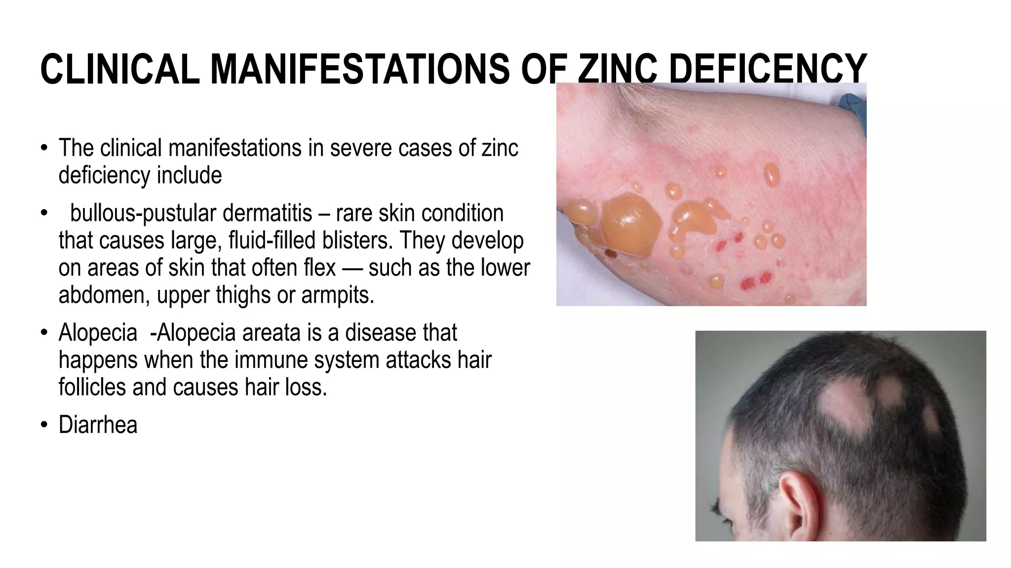 PHN - zinc deficiency.pptx