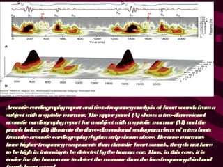 Phonocardiogram | PPT