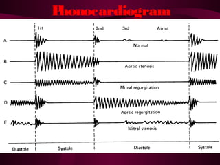 Phonocardiogram | PPT