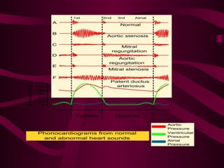 Phonocardiogram | PPT