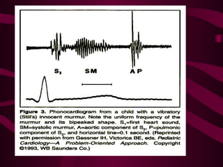 Phonocardiogram | PPT