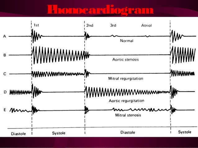 Phonocardiogram