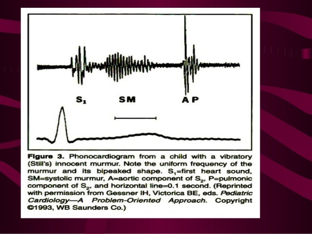 Phonocardiogram