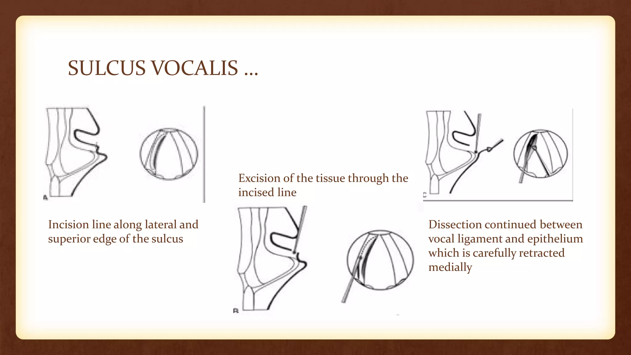 Phonosurgery | PDF