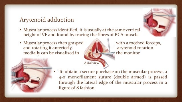 Phonosurgery