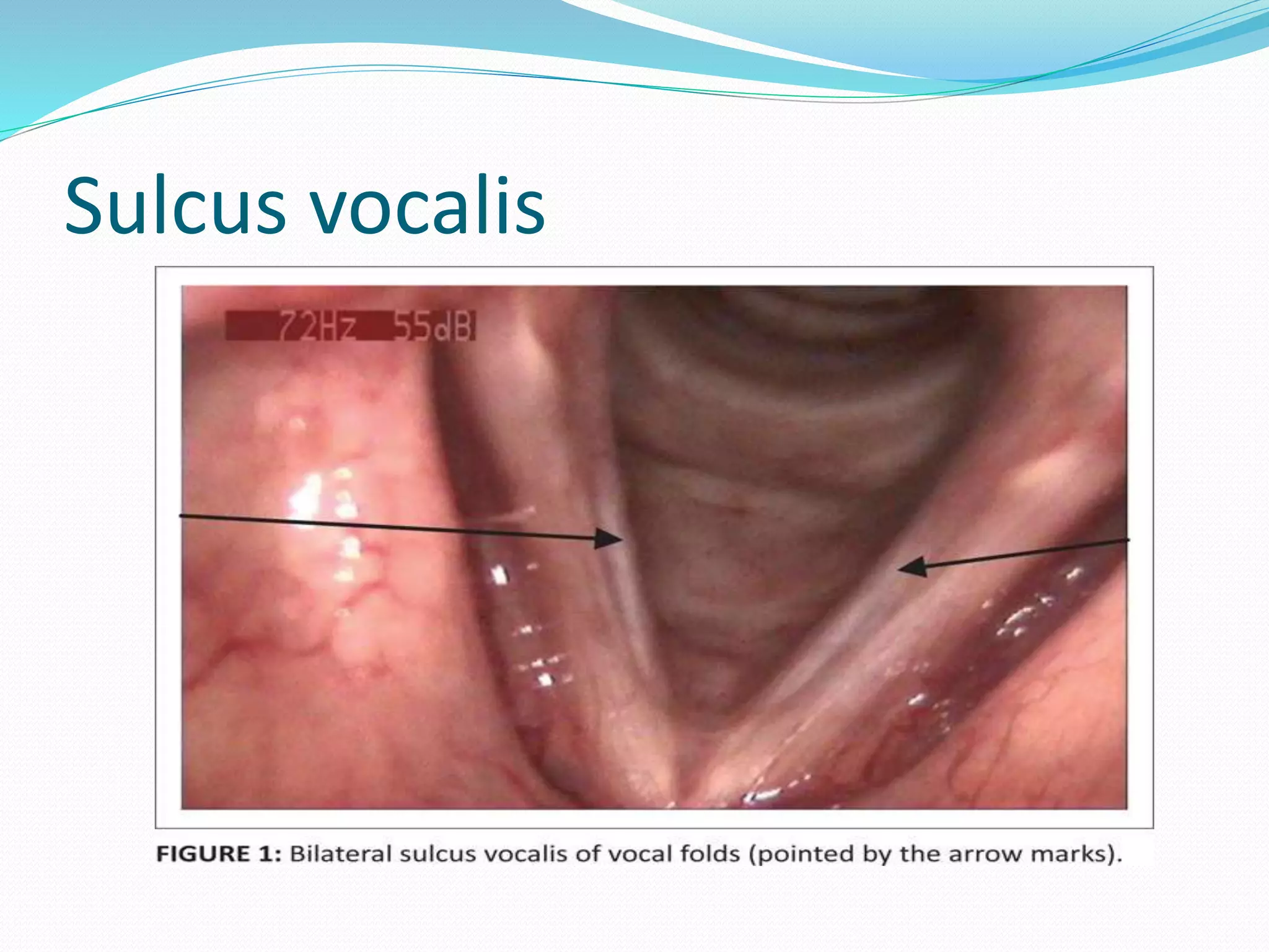 Phonosurgery and speech therapy | PPTX
