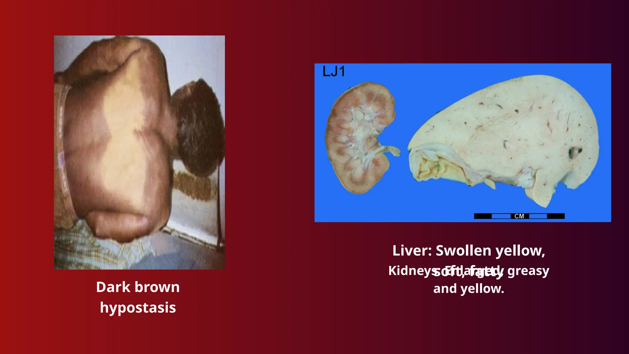 phosphorus poisoning powerpoint forensic | PPTX