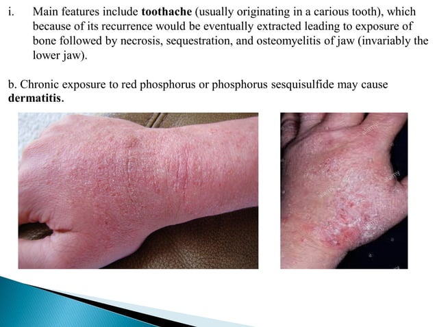 Phosphorus poisoning | PDF | Chemistry | Science