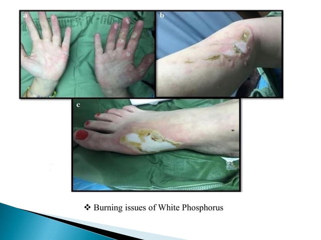 Phosphorus poisoning | PDF | Chemistry | Science