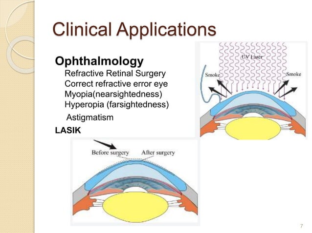 Laser Photoablation | PPTX | Eye and Vision Conditions | Diseases and ...