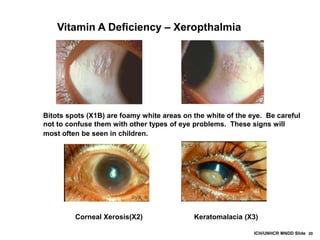 Photocards.ppt | Thyroid Disorders | Endocrine and Metabolic Diseases