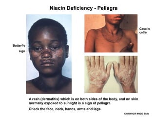 Photocards.ppt | Thyroid Disorders | Endocrine and Metabolic Diseases