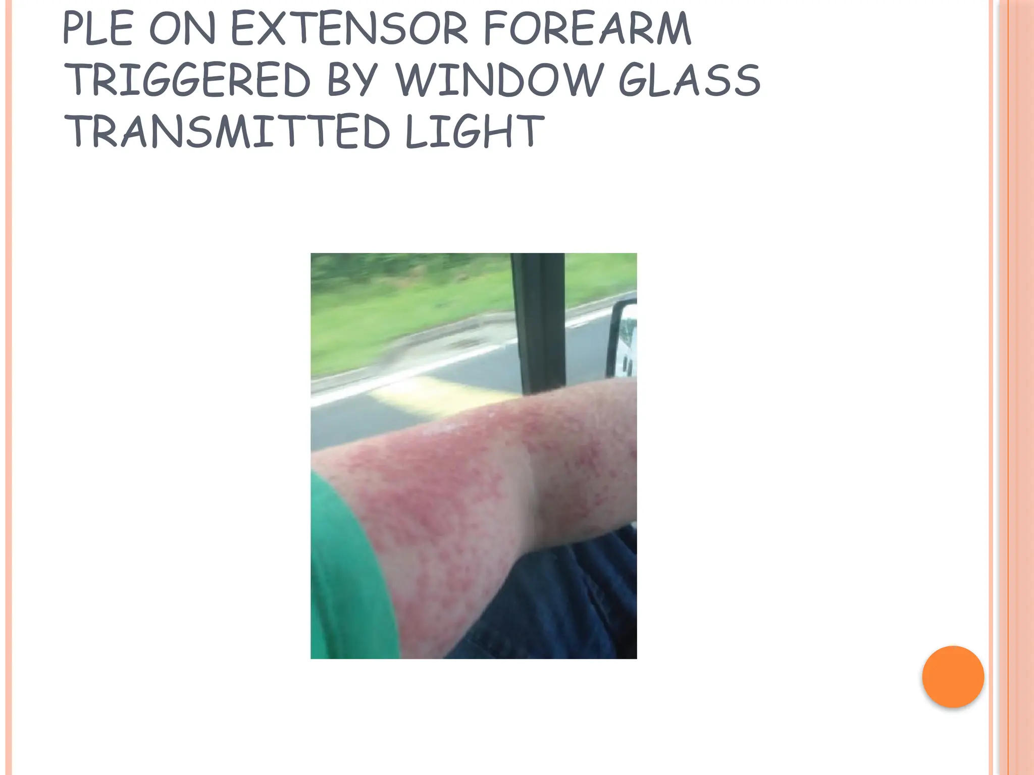 Photobiology and photosensitive dermatoses | PPTX