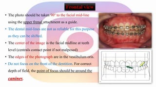 Photography in Orthodontics | PPTX