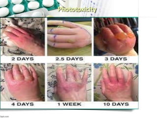 Photosensitivity | PPTX