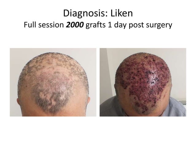Surgical treatment of Cicatricial Alopecia. | PPT