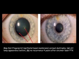 Phototherapeutic keratectomy | PPT | Eye and Vision Conditions ...