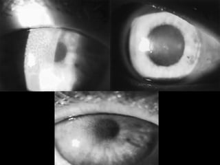 Phototherapeutic keratectomy | PPT | Eye and Vision Conditions ...