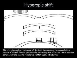Phototherapeutic keratectomy | PPT | Eye and Vision Conditions ...