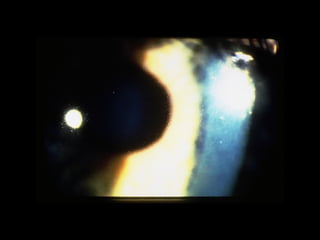 Phototherapeutic keratectomy | PPT